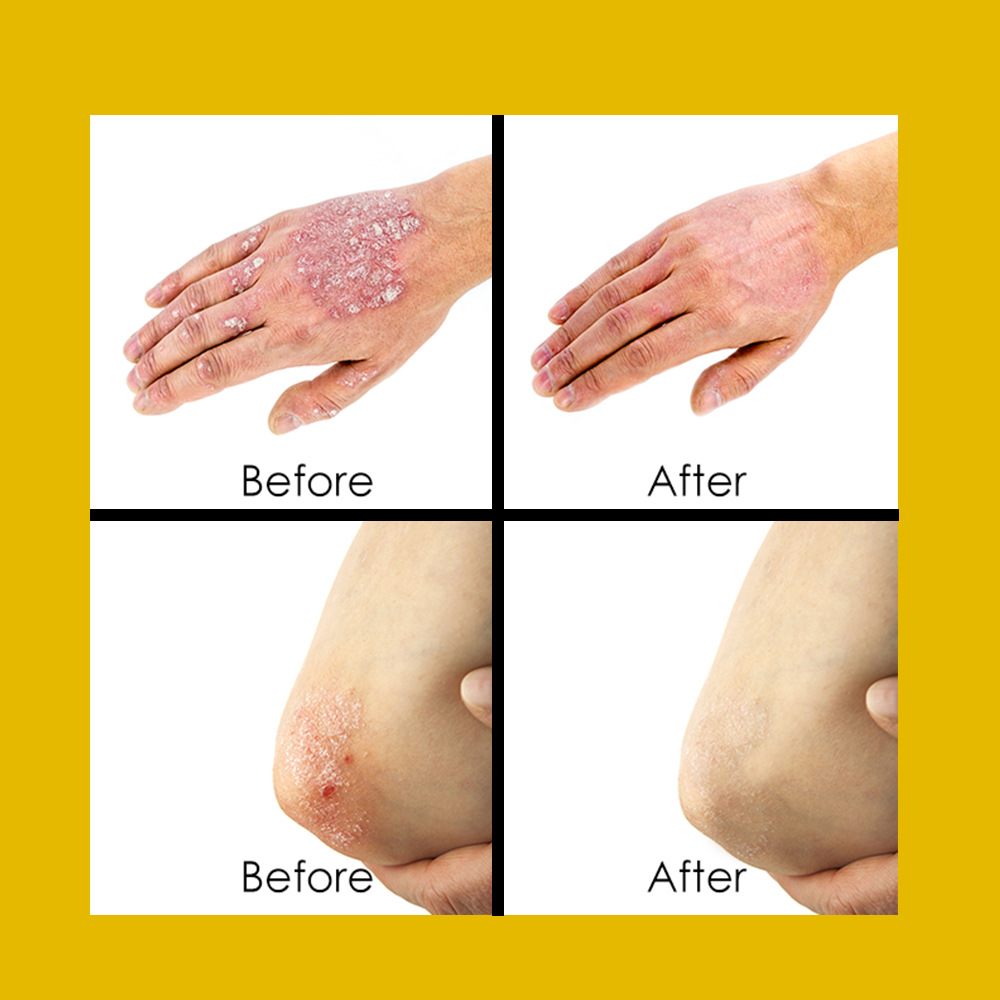 Psoriasis cream 20g for Erythema Ringworm Bacterial Tinea Eczema ...