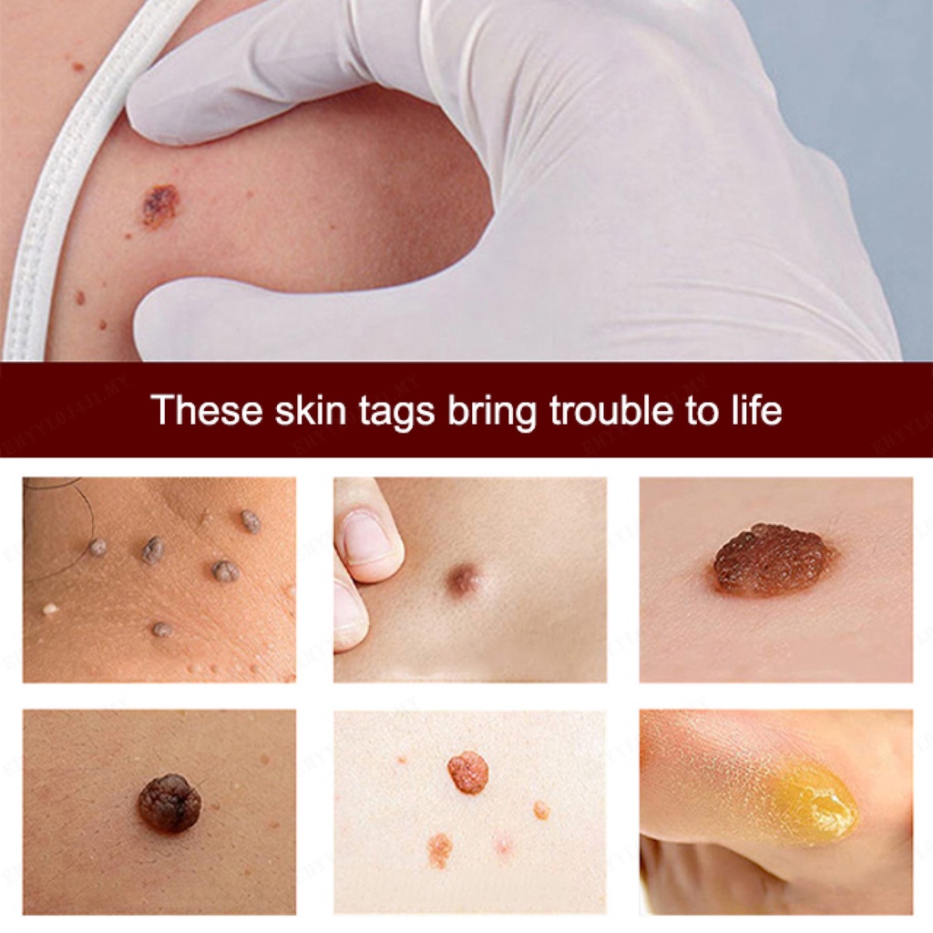Jaysuing Wart Removal Liquid Pen/Skin Tag Removal Pen Warts and Mole ...