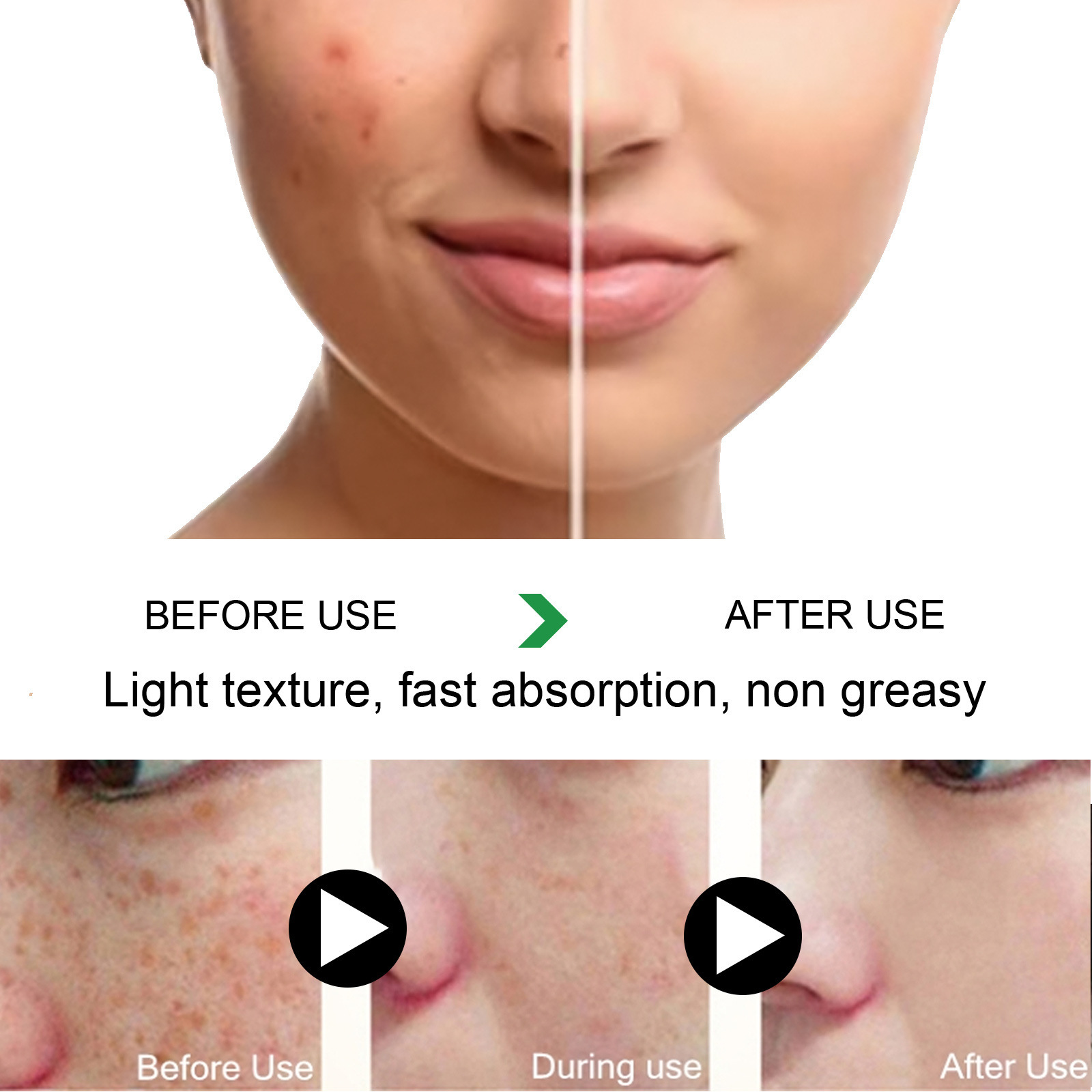 Freckle Cream, Acne Scar Removal Cream, Pigmentation Removal Cream for ...
