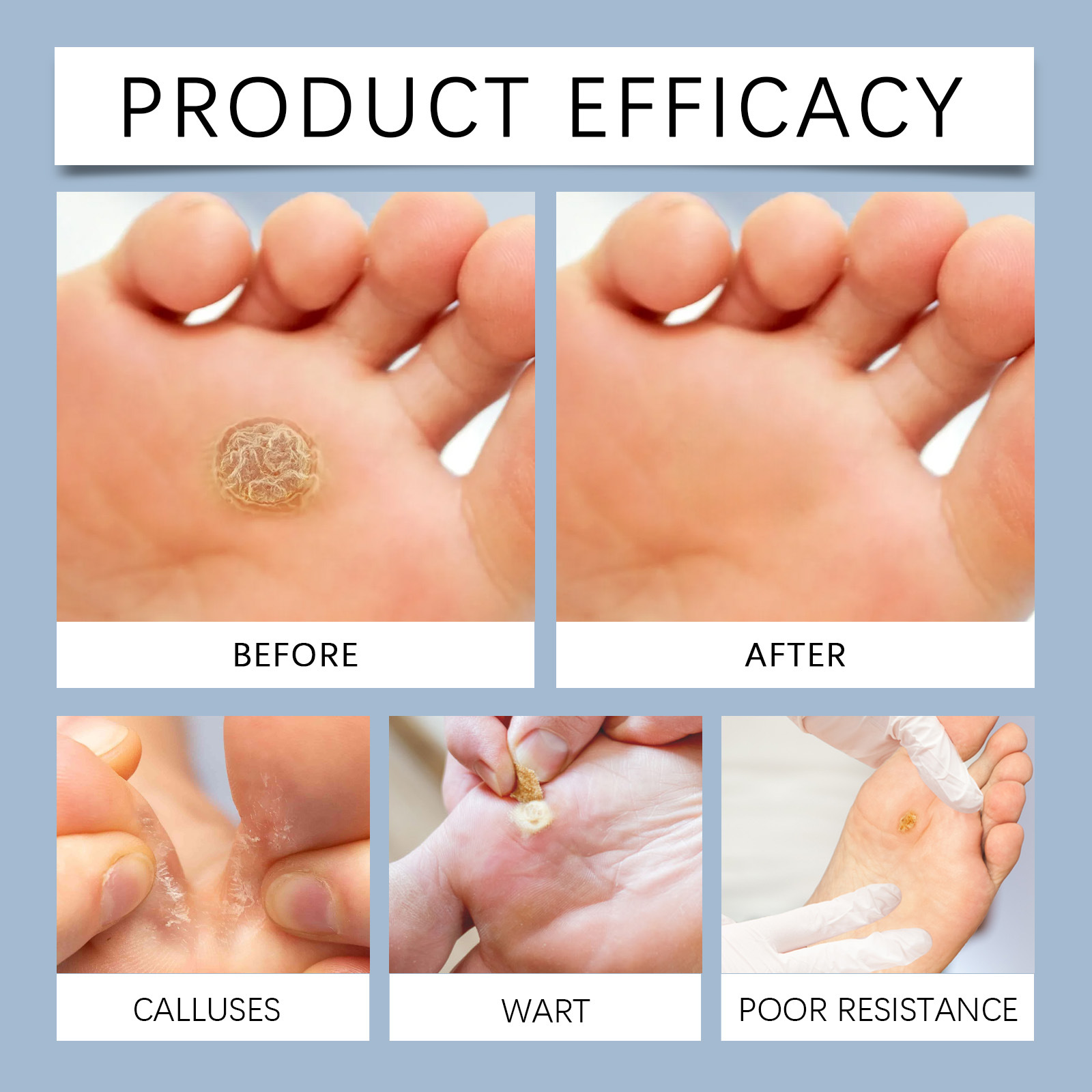 24pcs Plantar Wart Remover Pads, Wart Remover Bandaid for Plantar Wart ...