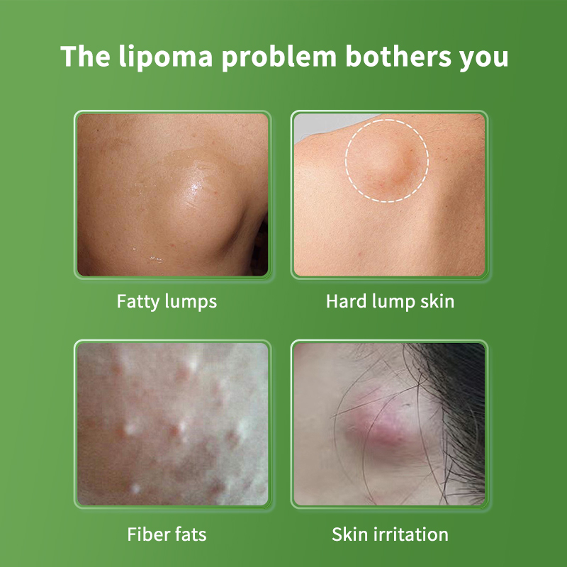 Lipoma Cream ubat benjolan Lipoma Removal Cream 20g Removal of internal ...