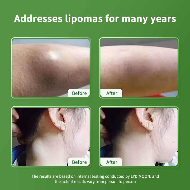 Lipoma Cream ubat benjolan Lipoma Removal Cream 20g Removal of internal ...