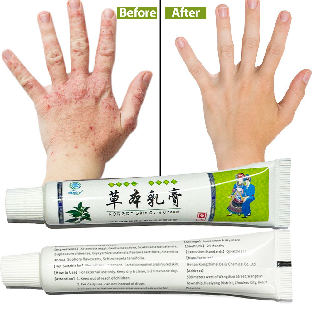 Kongdy 5Pcs Eczema Cream Psoriasis Treatment Ointment Herbal Skin Cream ...