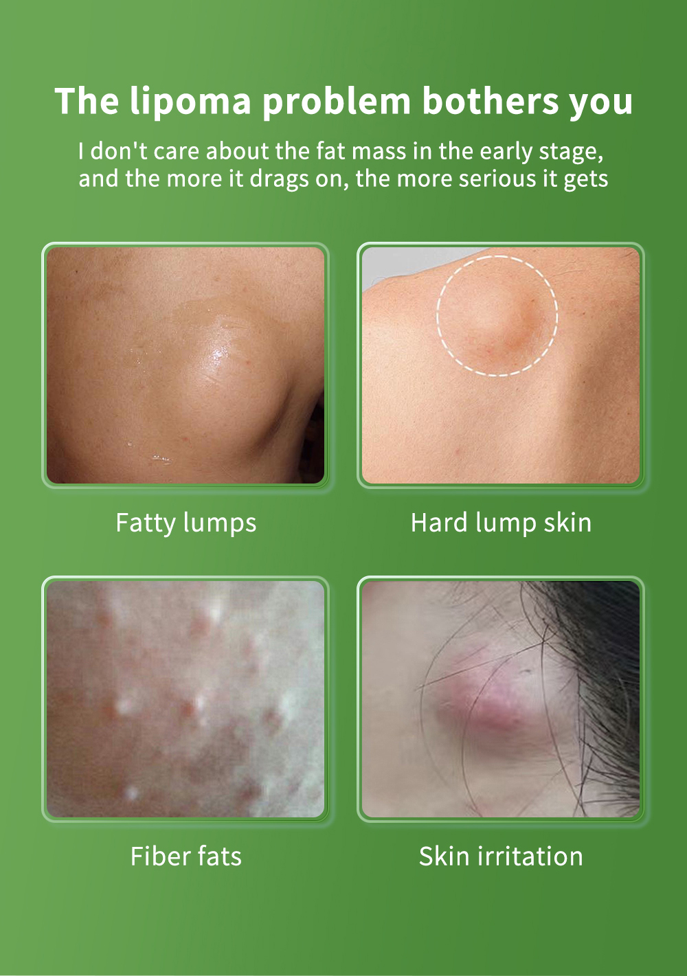 Genuine spot lipoma ointment 20g to remove body lumps, thyroid lumps ...