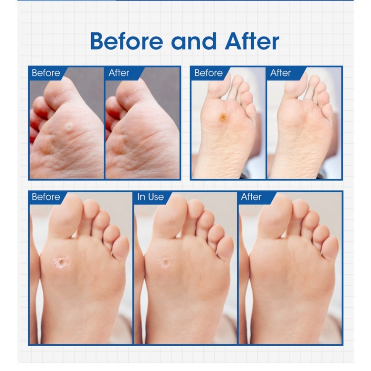 24PCS Warts Remover Patch Foot Corns Remover Pad Callus Removal Feet ...