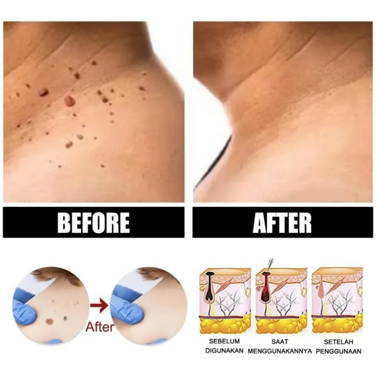 Original Skin Tag Removal Cream: Wart, Mole, Freckle, and Melanin Spot ...
