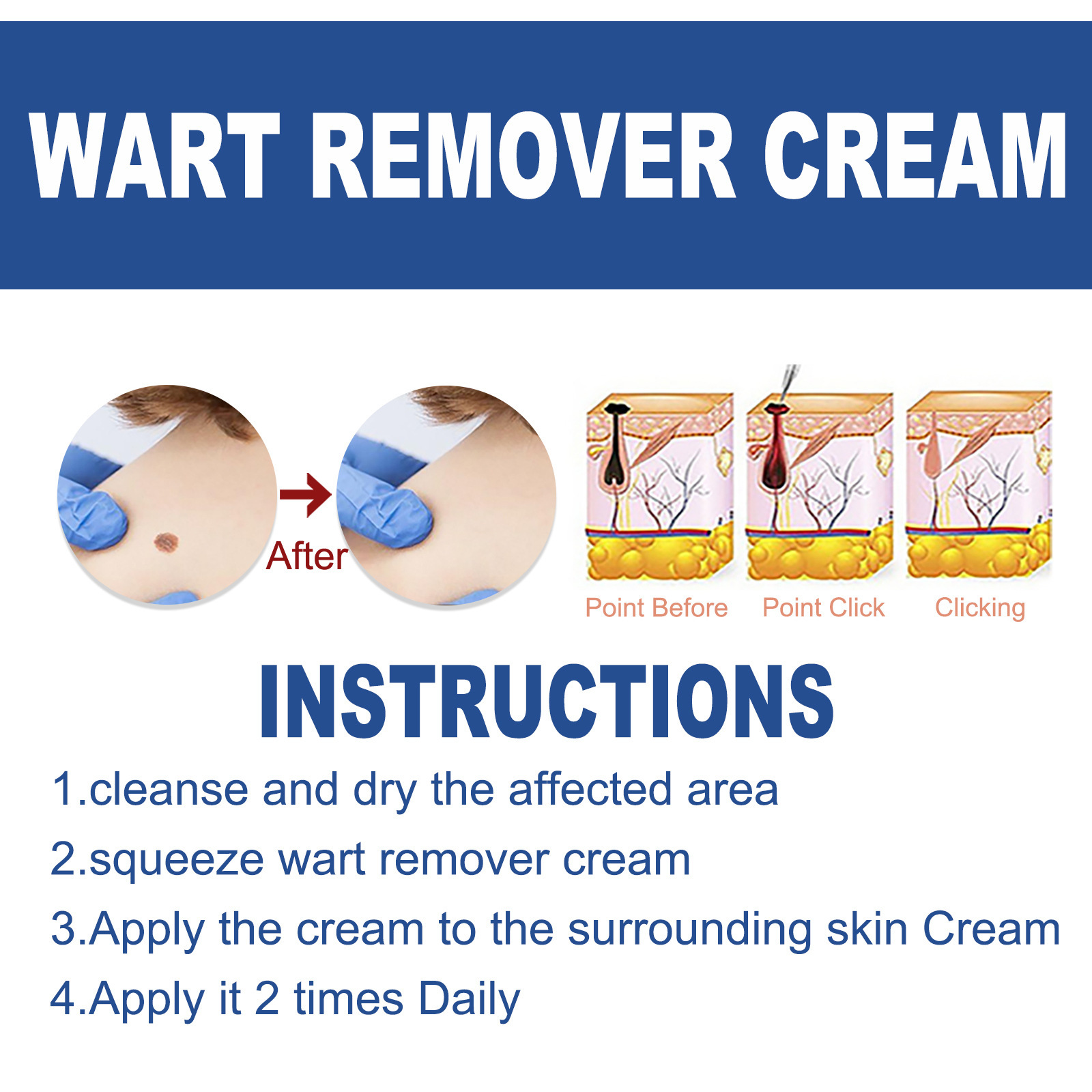 【Fast Effective 】Ubat buang kutil ketuat tahi lalat biji Mole Removal ...