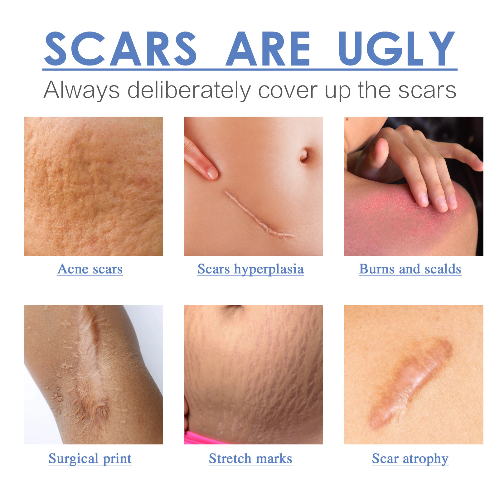 Silicone Scar Sheets, Silicone Scar Tape for Scar Removal Treatment ...