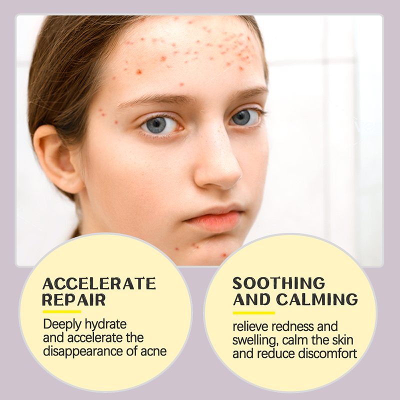 Acne Pimple Patches for Face, Hydrocolloid Acne Patches for Covering ...