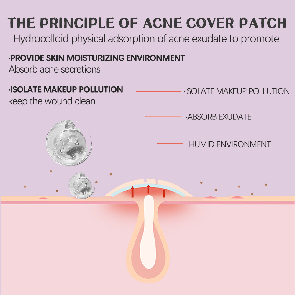 Acne Pimple Patches for Face, Hydrocolloid Acne Patches for Covering ...
