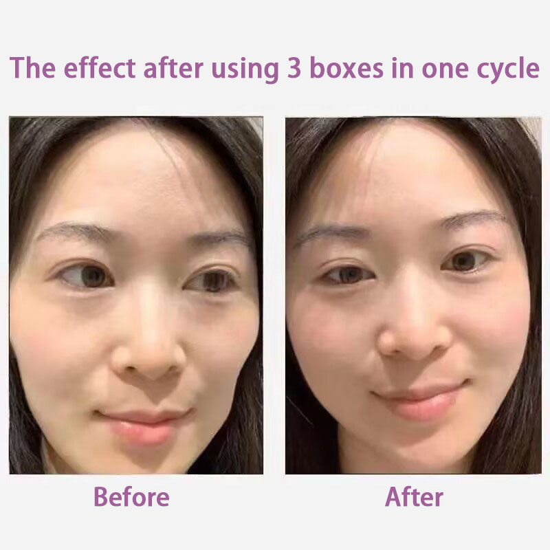 10 Pcs PPP HUNMUI 5pcs Nasolabial Folds Mask Fades Wrinkles Forehead ...