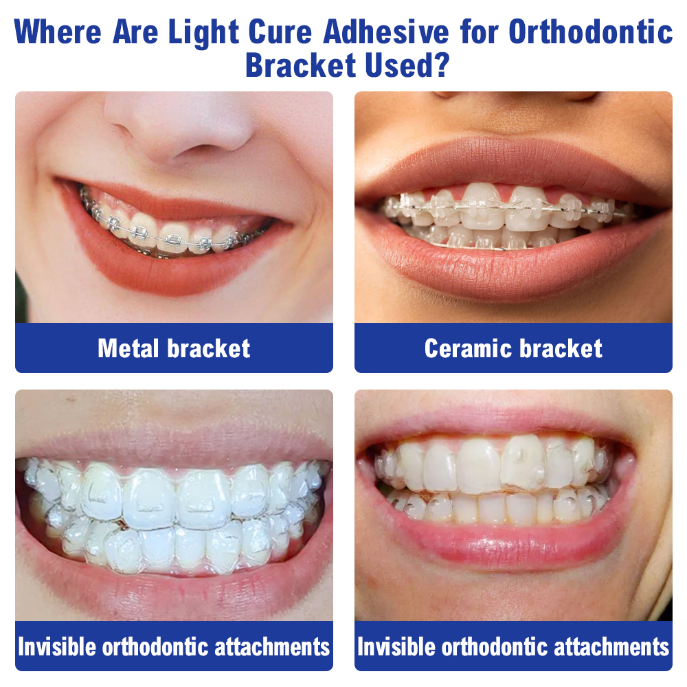 Dental Orthodontic Adhesive Light Cure Braces Glue Kit Paste Ortho ...