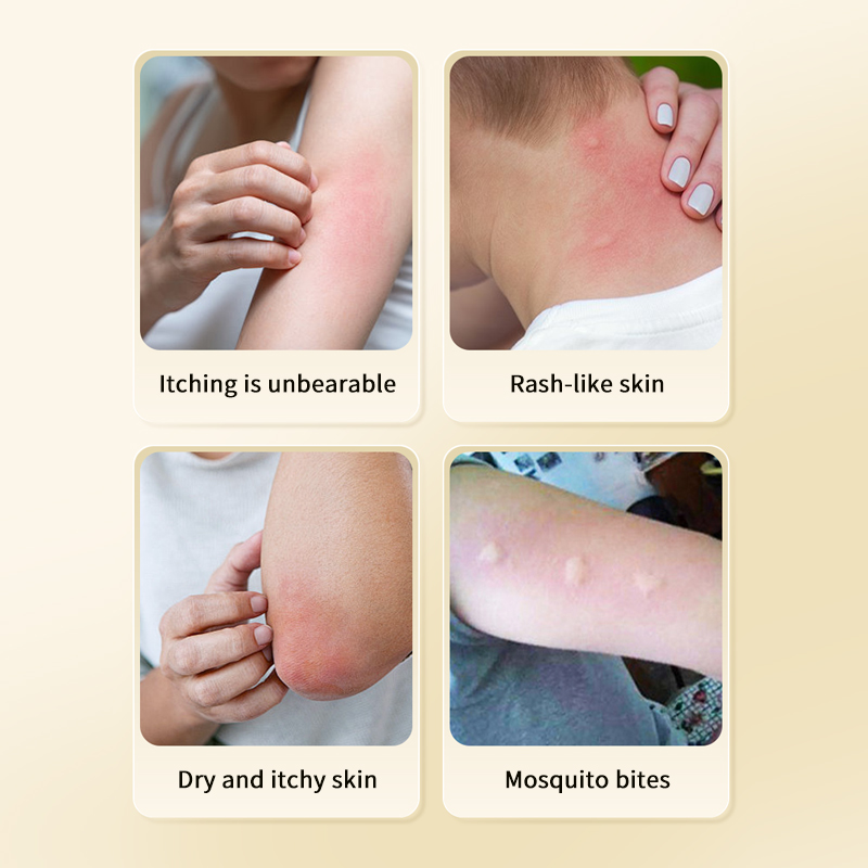 Eczema sulfur anti-itch cream for Skin problems Scabies rosacea ...