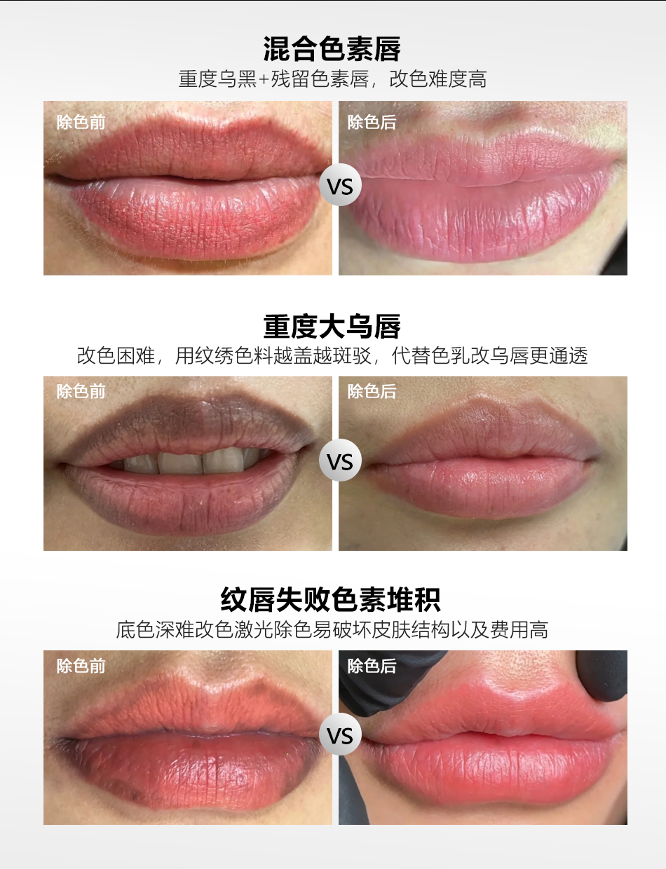 [Teaching Supply] GINZO Decolorizing Restoring Set Restoring Mom Lip Removing Melanin Liquid ...