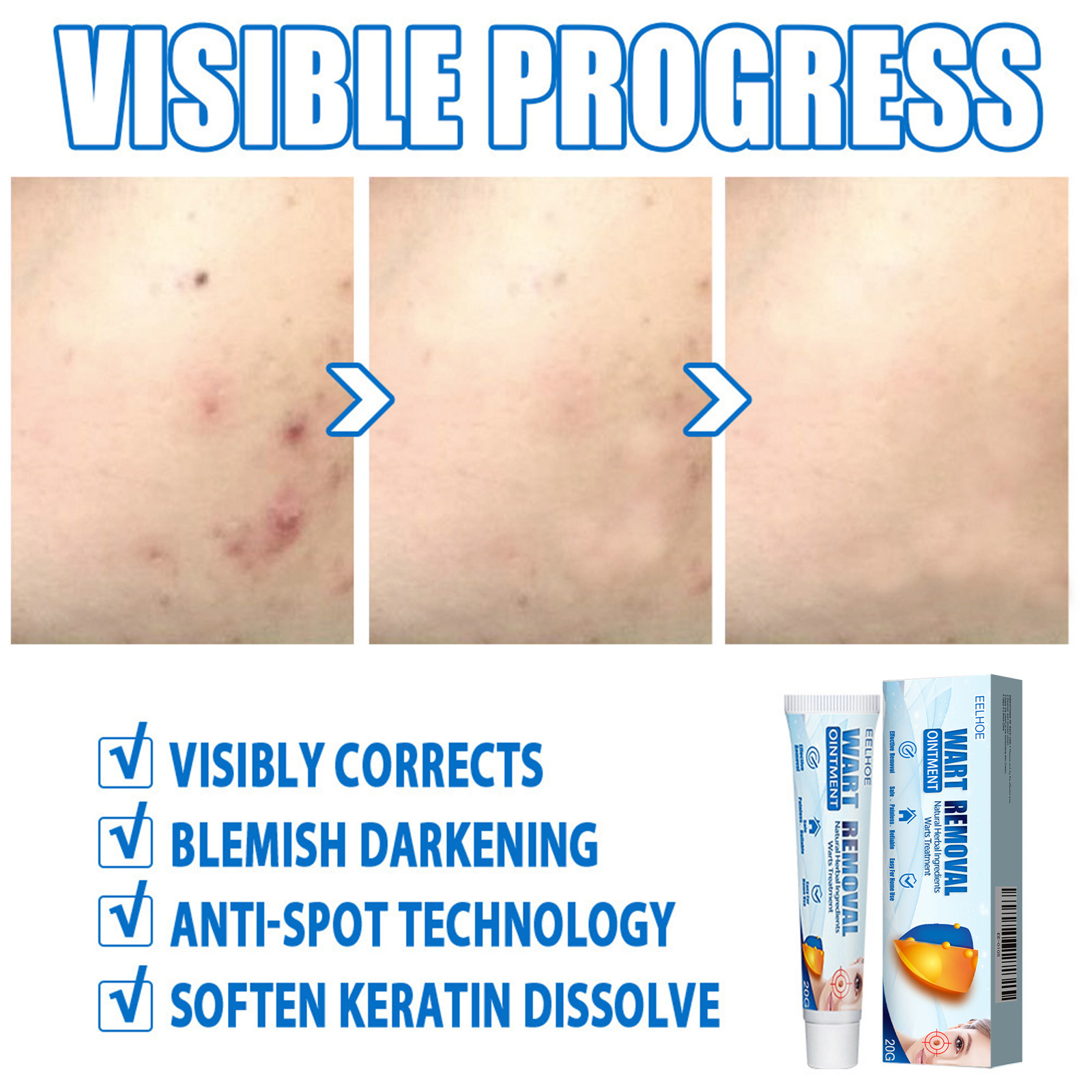 Eelhoe Warts Removal Cream 20g Treats Warts and Repairs Skin on The ...