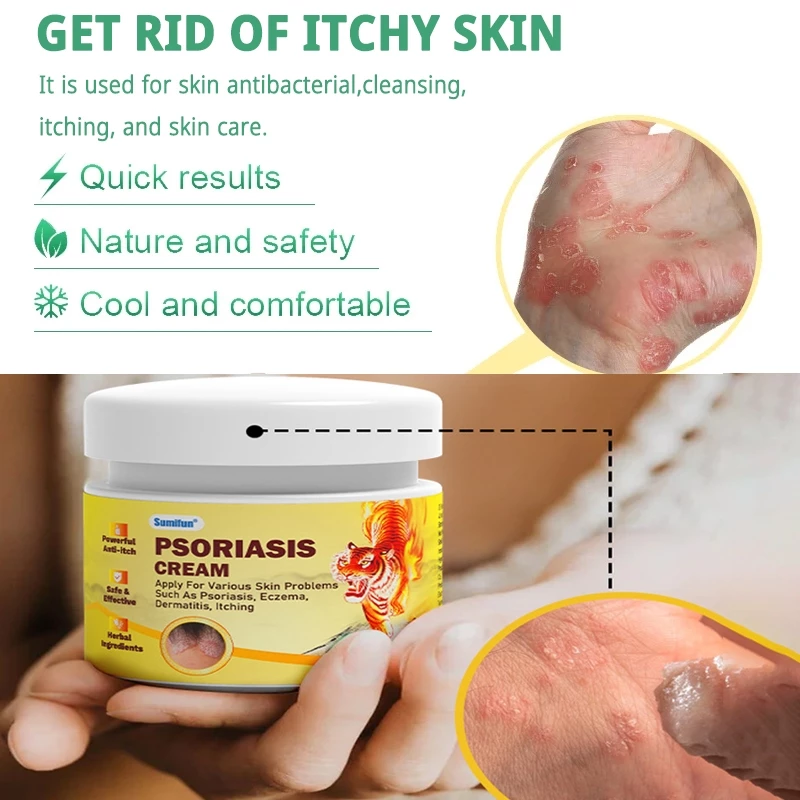 Ubat gatal Ubat kurap Psoriasis cream 20g Anti-Itch Remover Itchy Skin ...