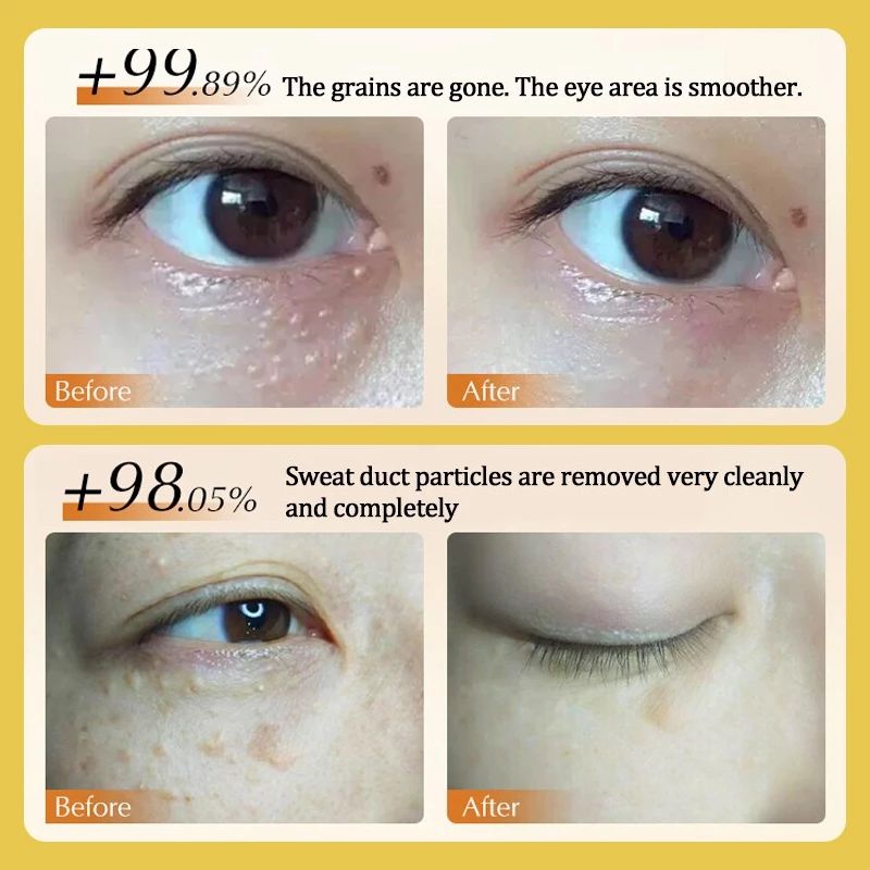 30g milia seed remover vitamin e eye cream syringoma milia remover ...