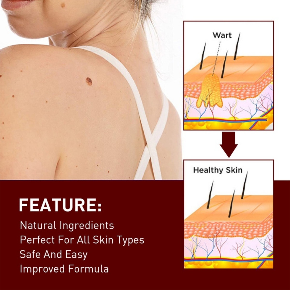 Anti-Verruca Skin Tag Removal Pen for Moles, Papillomas, and Warts Pena ...