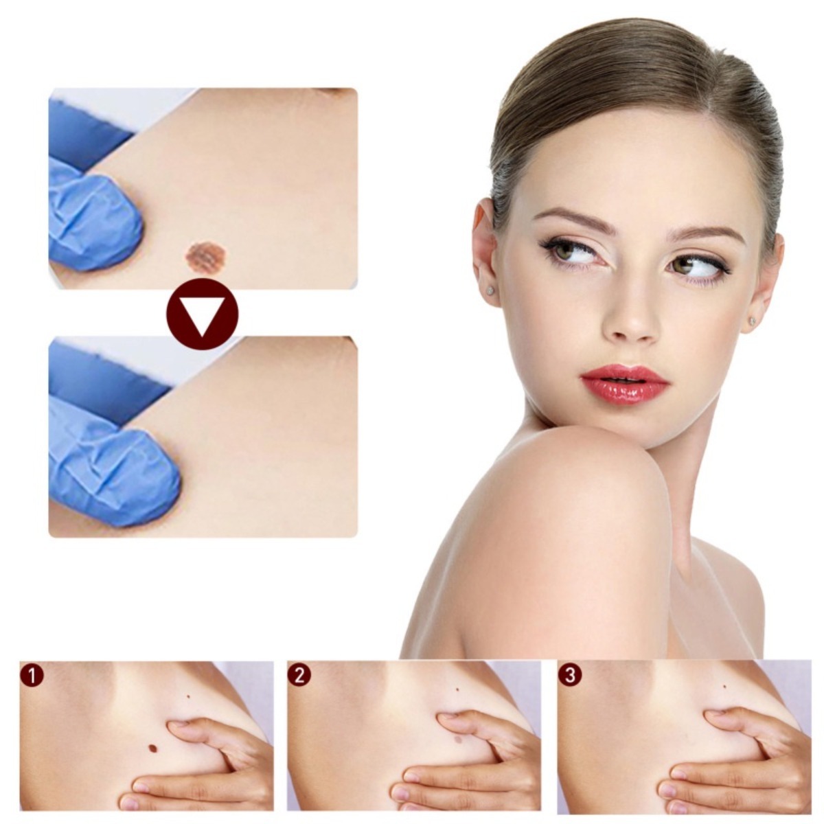Anti-Verruca Skin Tag Removal Pen for Moles, Papillomas, and Warts Pena ...