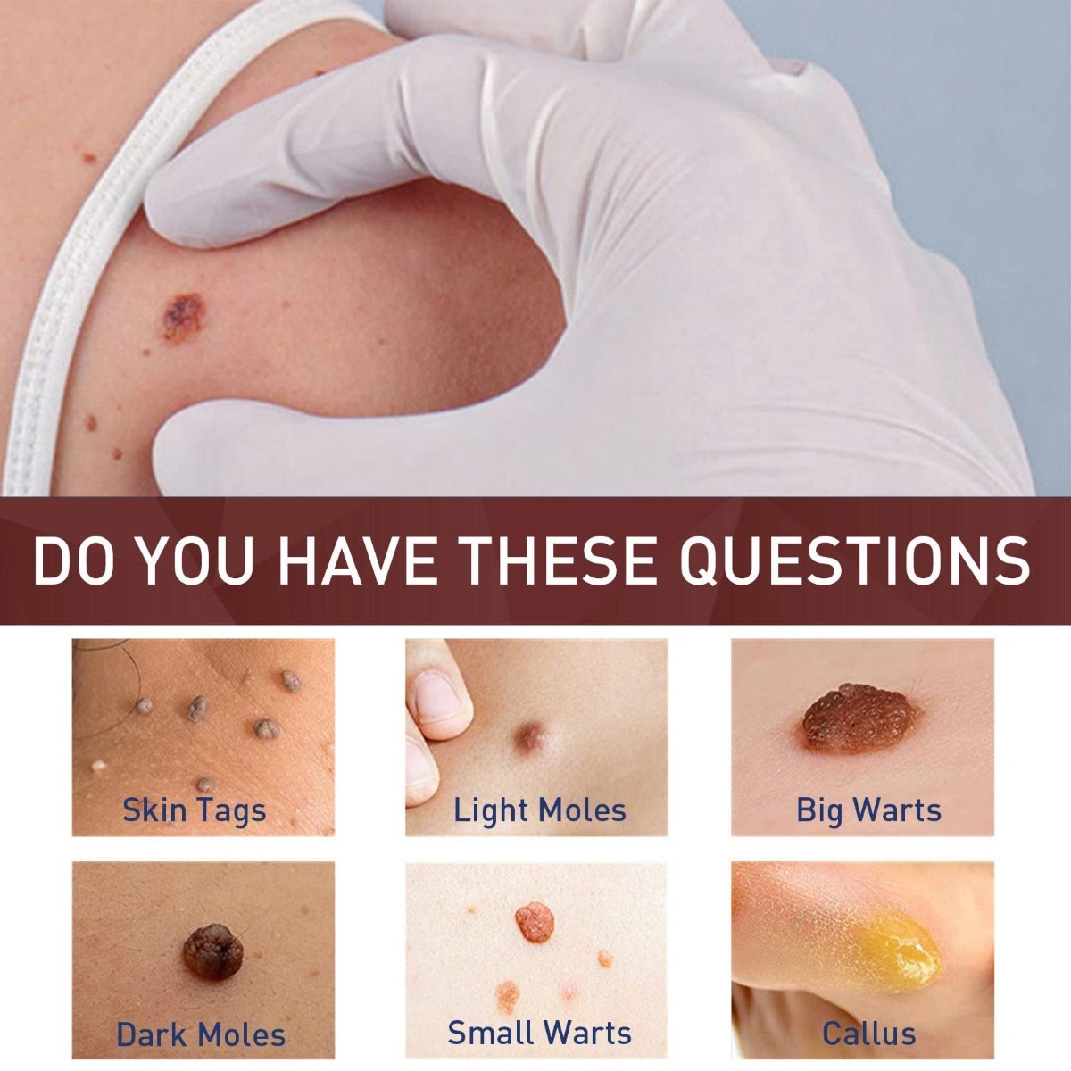 Anti-Verruca Skin Tag Removal Pen for Moles, Papillomas, and Warts Pena ...