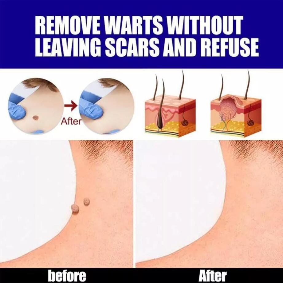 Ethereal Wart Remover Cream Fast Acting Herbal Ointment for Warts ...