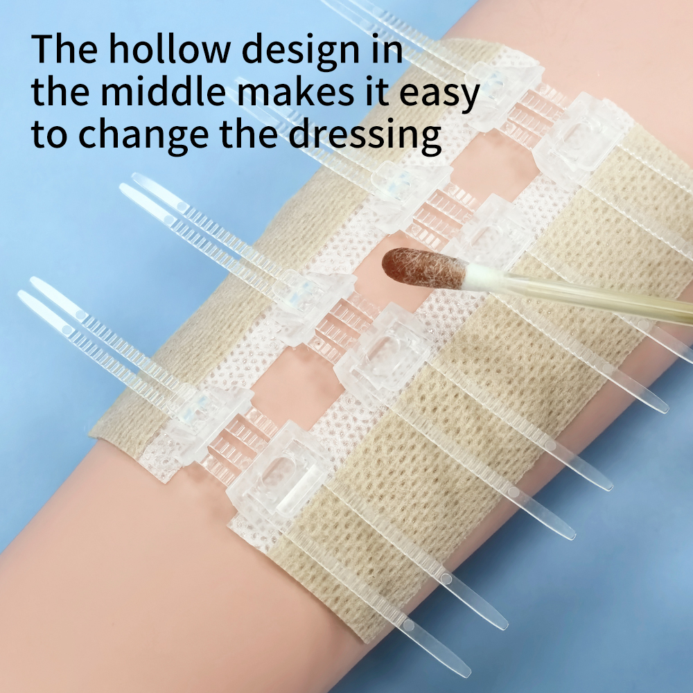 Medical Wound Closure Strips Free Latches Zip Sutures Bandages Self ...