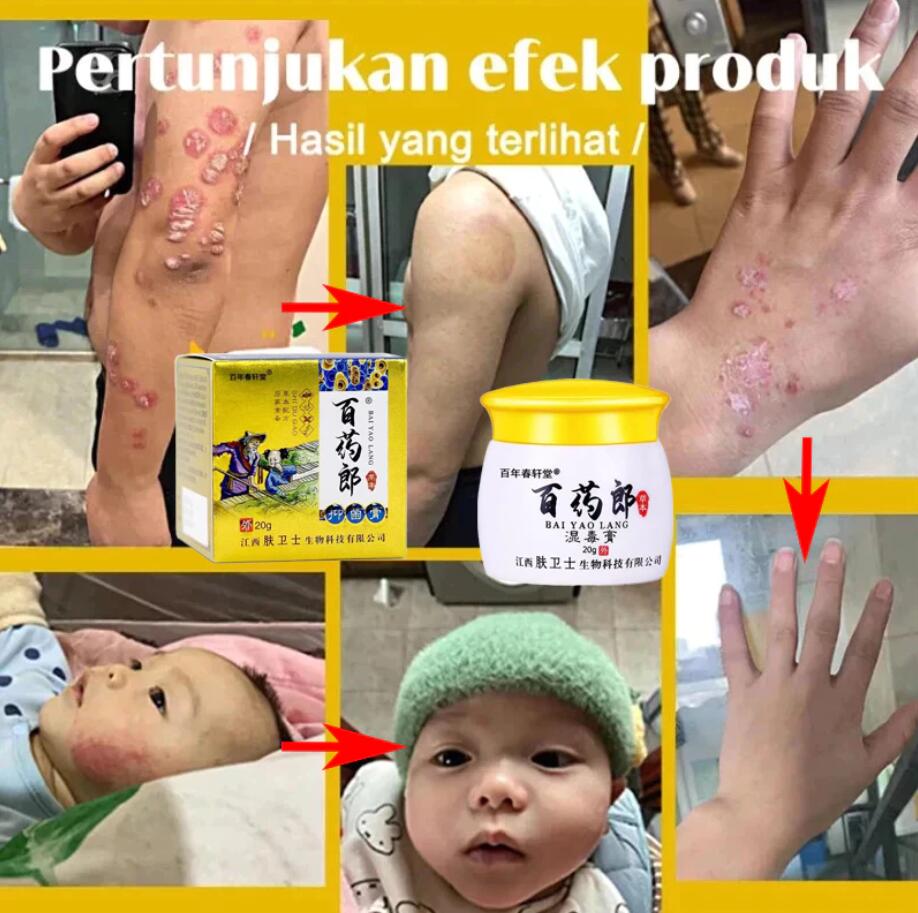Bai Yao Lang 20g Herbal Ointment Cream for Eczema, Rash, Redness & Skin Repair – Buy 1 Get 1 ...