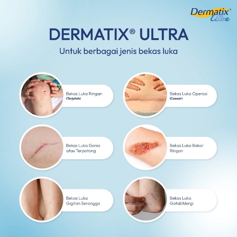 Dermatix Ultra Scar Gel 15g Dermatic Acne Scar Reduction Cream Advance ...