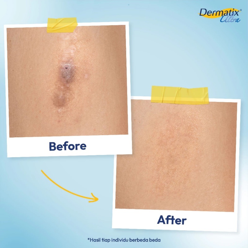 Dermatix Ultra Scar Gel 15g Dermatic Acne Scar Reduction Cream Advance ...