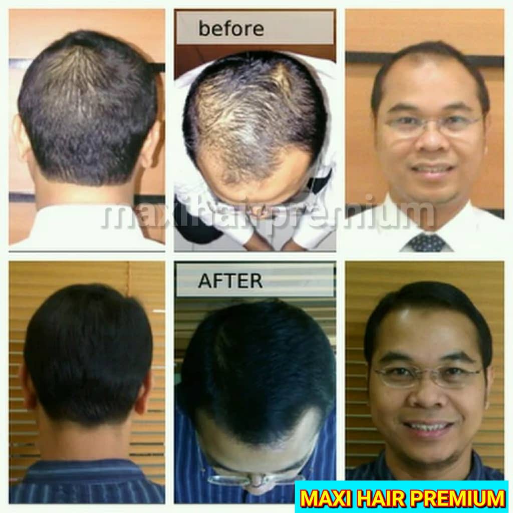 (3box) Vitamin Penumbuh Pelebat Rambut Gugur, Botak, Alopecia ...