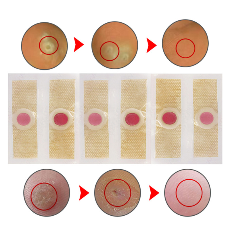 Effective 10Pcs Wart Removal Stickers Skin Tag Relief Patch Medical ...