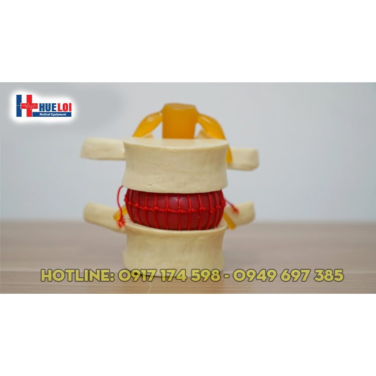 Herniated Disc Surgery 9871