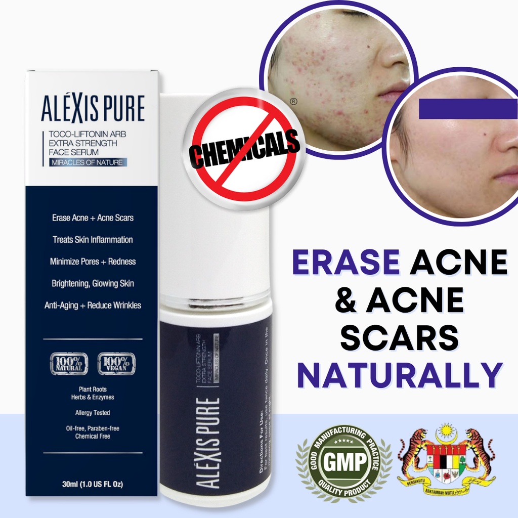 Alexis Pure Herbal Face Serum: Reduce Acne, Acne Scars & Pores, Remove ...
