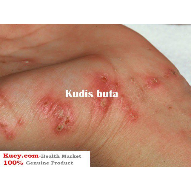 Ubat Kudis Buta, Kutu Kepala Scaboma Lotion For Scabies Kudis Buta Kutu ...
