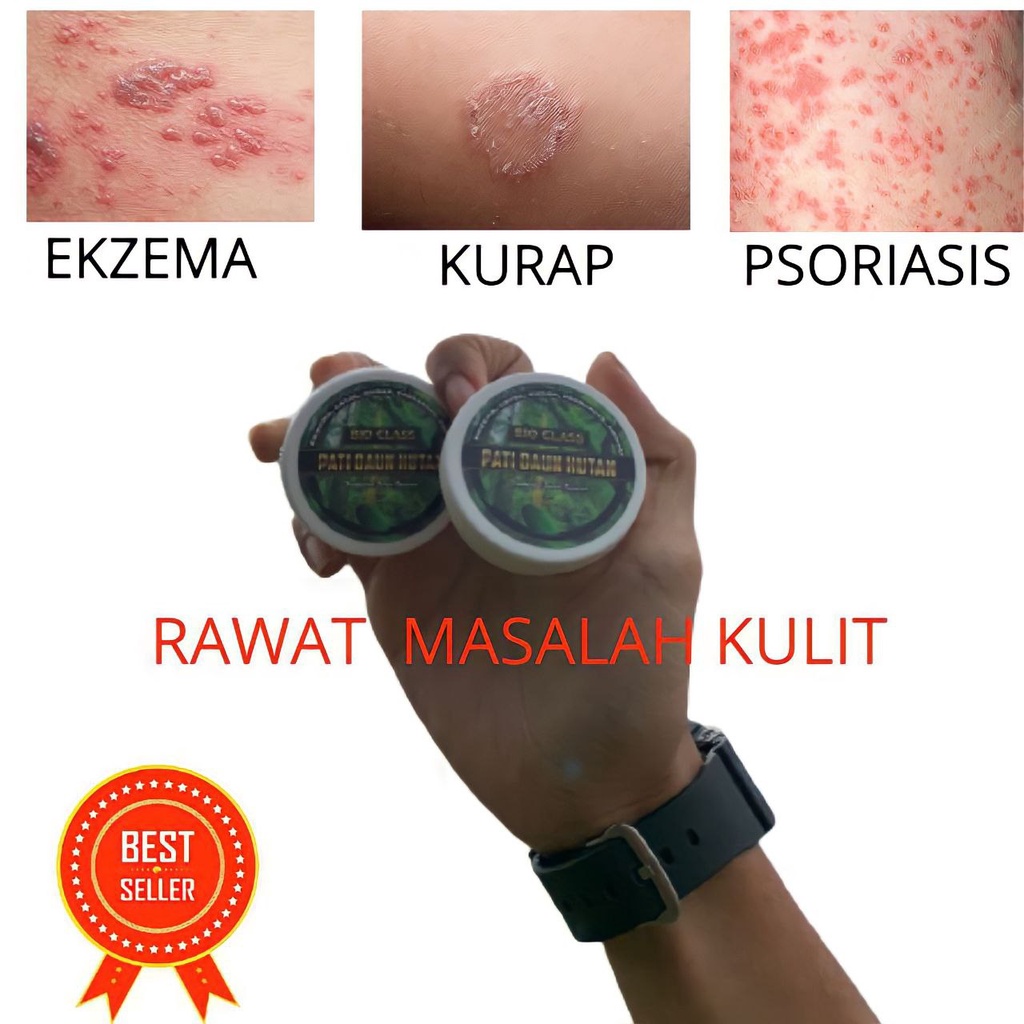 [ LOWEST PRICES] Cream Eczema Ubat Kurap Dan Gatal Antifungal Cream ...