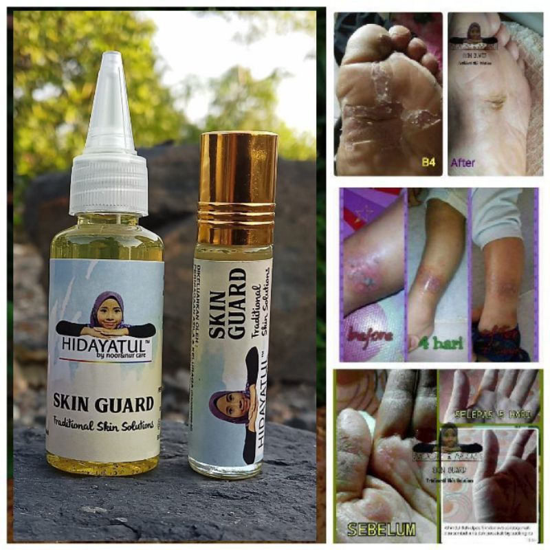 Minyak traditional, utk kudis, kayap, ruam, luka, bisul, makan air ...