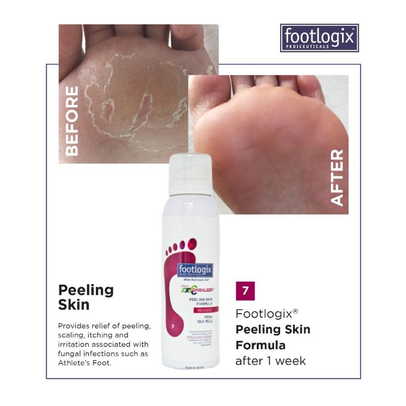 Footlogix #7 Peeling Skin Formula 125ml exp2025 | Shopee Malaysia