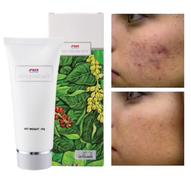 CNI Nutrimoist 50gram-Acne cream Scar remover, Eczema, Burns, Insects ...