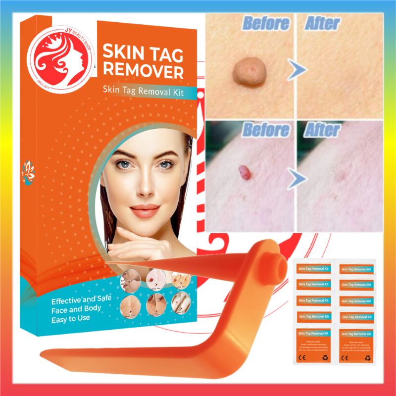 Medical Skin Tag Removal Kit Skin Wart Remover Micro Band Skin Tag ...