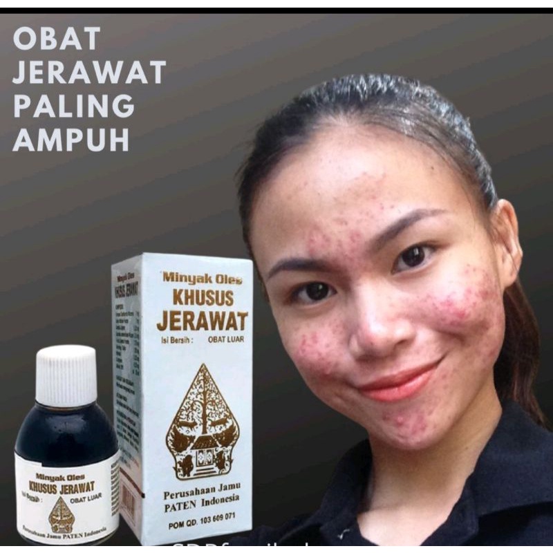 Wayang CAP Acne Medicine - Severe Acne Oil CAP WAYANG ORI BPOM | Shopee ...