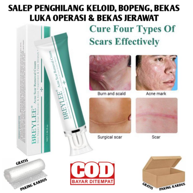 Keloid, BOPENG, Surgery Scars & Acne Scars Removal Ointment | Shopee ...