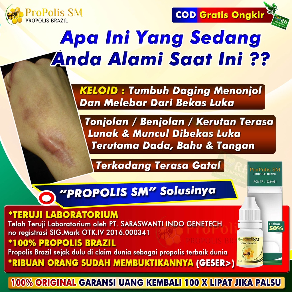 Natural Keloid Drugs Remove, Disguise And Cure Keloids Completely With ...