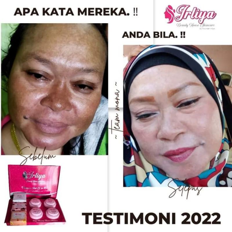 SKINCARE IRLIYA BEAUTY SET EXCLUSIVE (JERAGAT)(FLEK HITAM)(JERAWAT ...