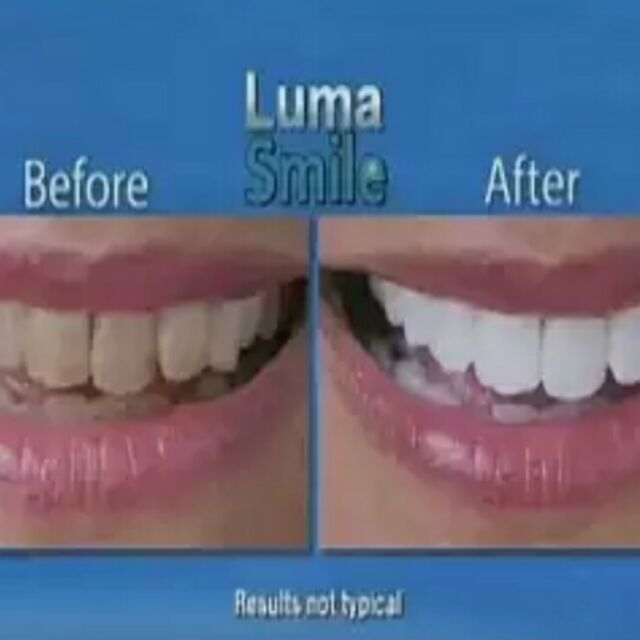 Luma smile Whitening Teeth | Shopee Malaysia