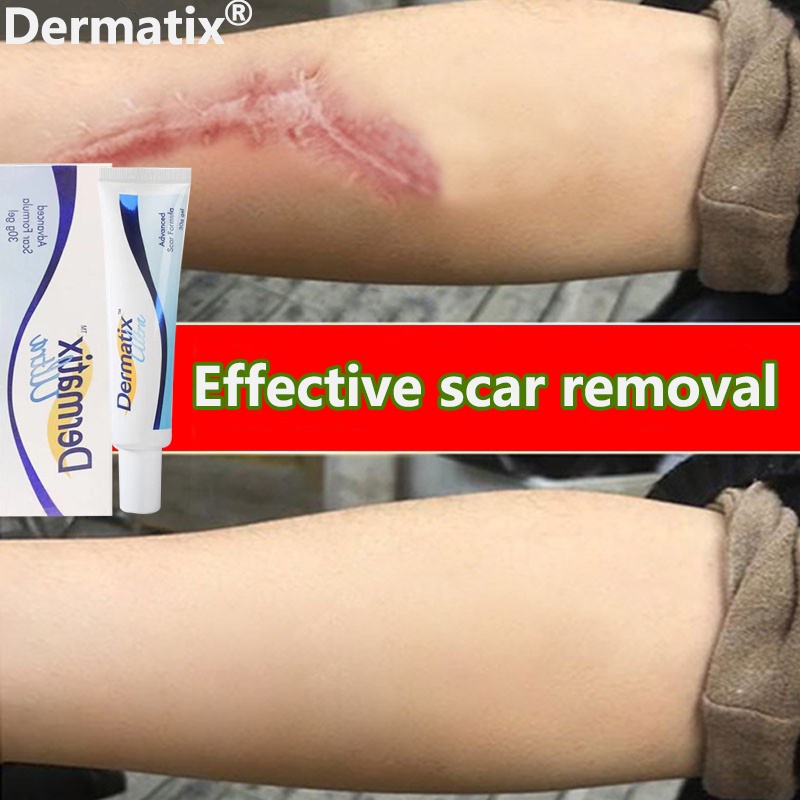 【Effective】30g Scar Removal Cream Scar Gel Acne Scars Treatment Old ...