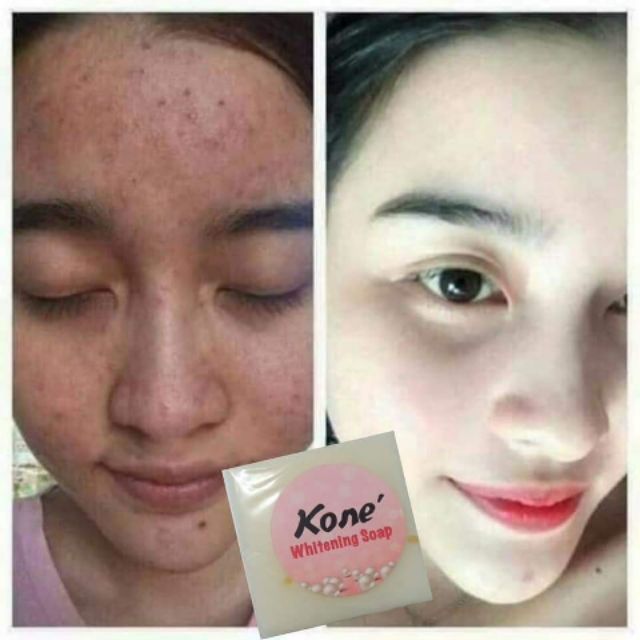 🔥KONE SKINCARE SET & SOAP FOR FACIAL TREATMENT🔥 | Shopee Malaysia