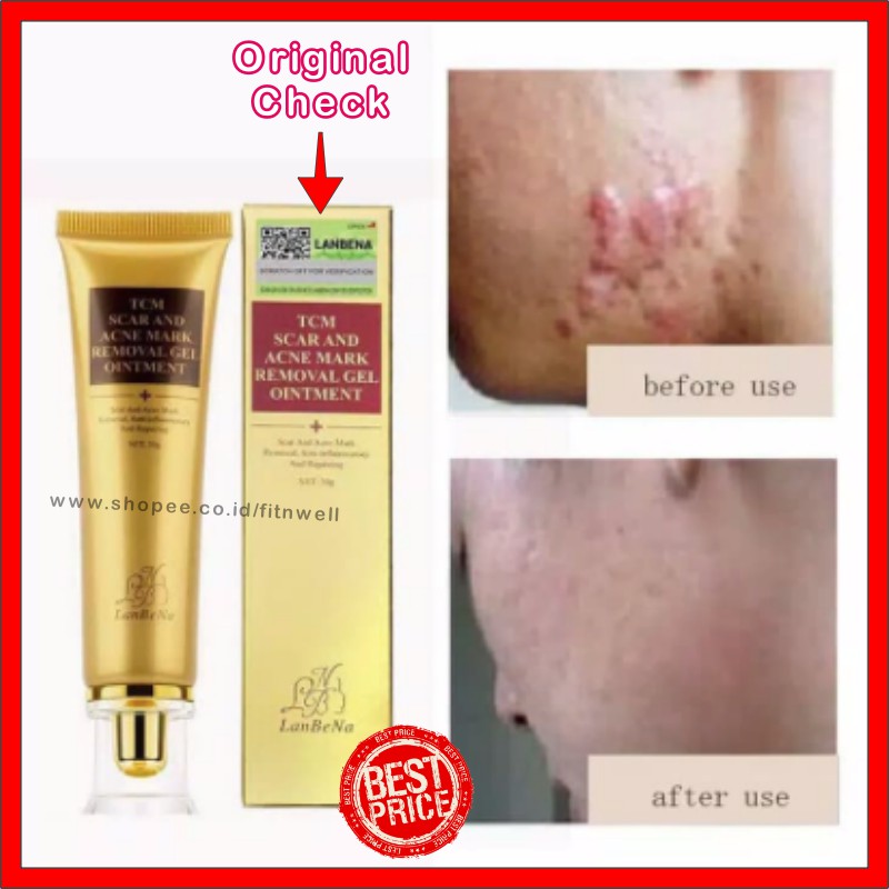Lanbena ORIGINAL Acne Scar, Surgery & Wound Remover/TCM Scar and Acne ...