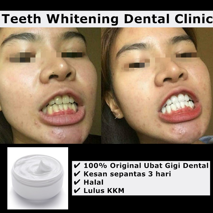 Ubat Pemutih Gigi Formula Doktor Gigi CEPAT PUTIH 20gram Whitening ...