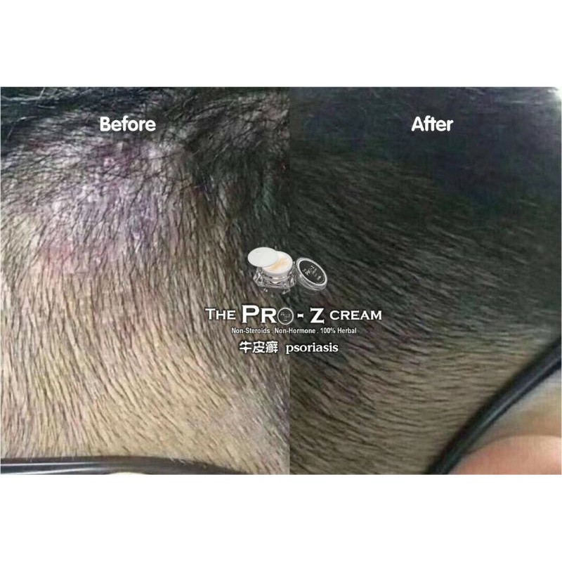 THE PROZ CREAM 5GRAM- KRIM EKZEMA/KURAP (99% HEALED ECZEMA, PSORIASIS ...