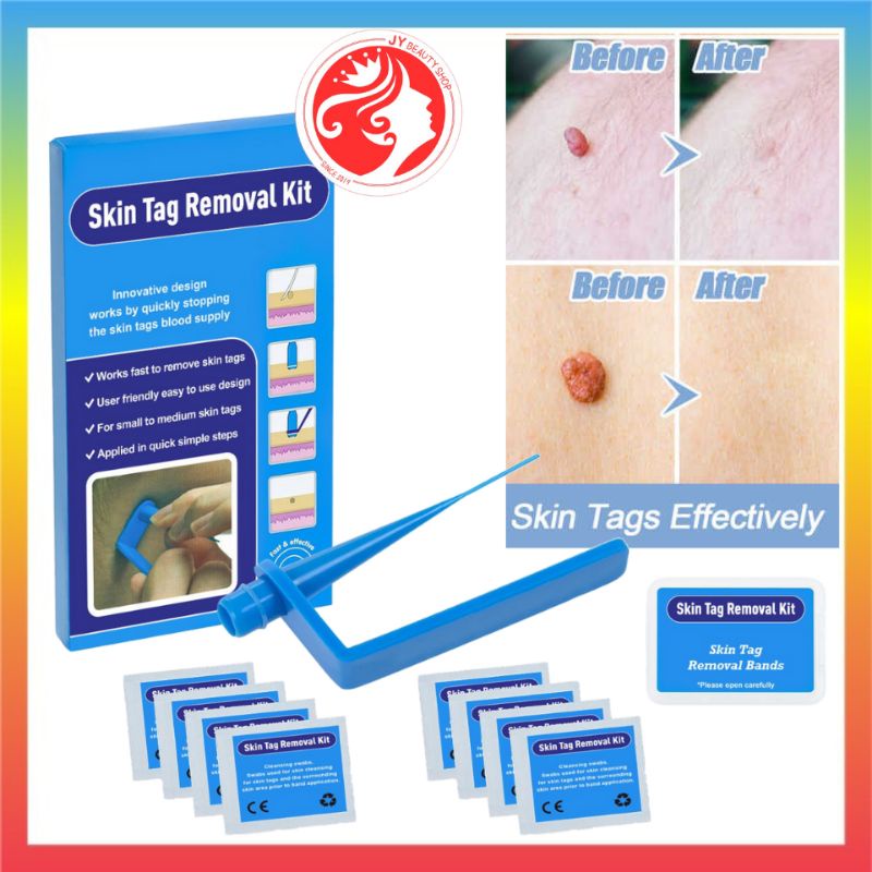 Medical Skin Tag Removal Kit Skin Mole Wart Remover Micro Band Skin Tag ...